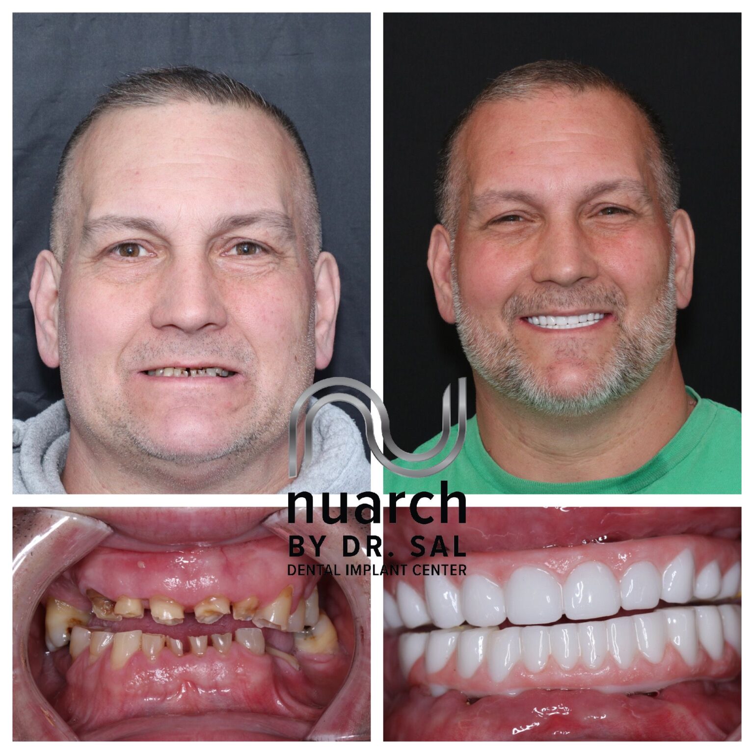 Full Mouth Dental Implant Before & After Photos · Dental Implant Center