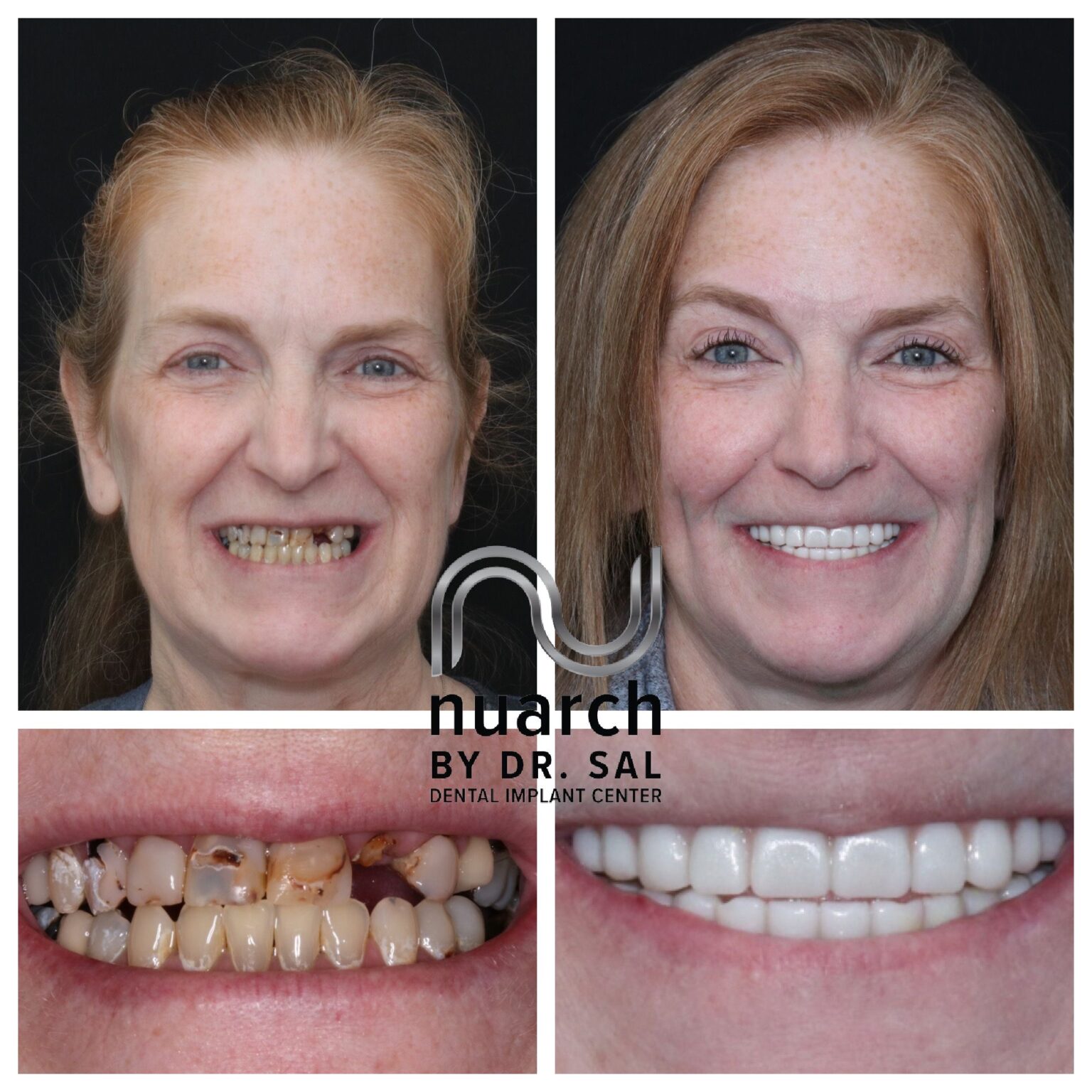 Full Mouth Dental Implant Before & After Photos · Dental Implant Center